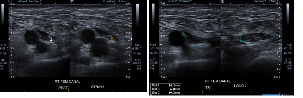 Queryfemoralherniaimages – Bird Ultrasound