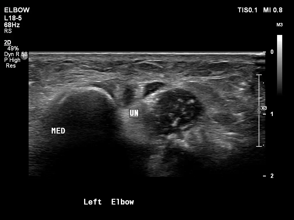 ULTRASOUND-LEFT-ELBOW-0003 – Bird Ultrasound